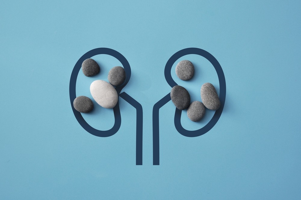 What Causes Recurring Kidney Stones? | Dr. Edward J. Sanchez